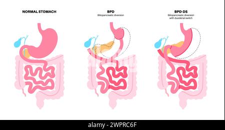 Biliopancreatic diversion procedure, illustration Stock Photo - Alamy