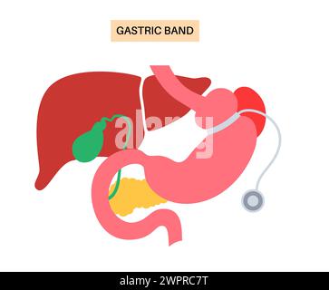 Illustration of gastric banding. A laparoscopic adjustable gastric band ...