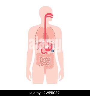 Illustration of gastric banding. A laparoscopic adjustable gastric band ...