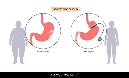 Gastric band medical procedure, illustration. Adjustable gastric ...