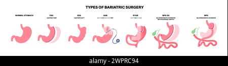 Types of bariatric surgery, illustration. Healthy stomach and internal ...