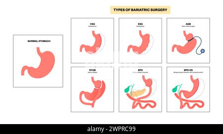 Types of bariatric surgery, illustration. Healthy stomach and internal ...