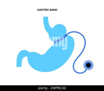 Illustration of gastric banding. A laparoscopic adjustable gastric band ...
