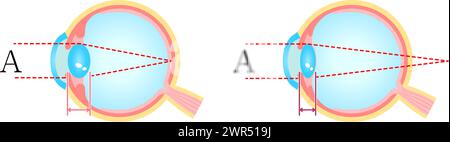 Causes and mechanism of cataract vector illustration Stock Vector Image ...