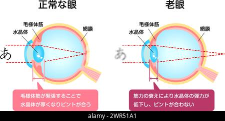Causes and mechanism of cataract vector illustration Stock Vector Image ...