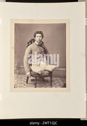 Amputation of both Thighs for Gunshot Injury. Possibly William H. Bell ...