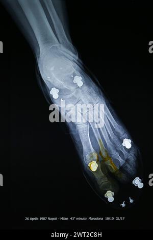 An x-ray of Diego Armando Maradona's foot in the museum of madness ...
