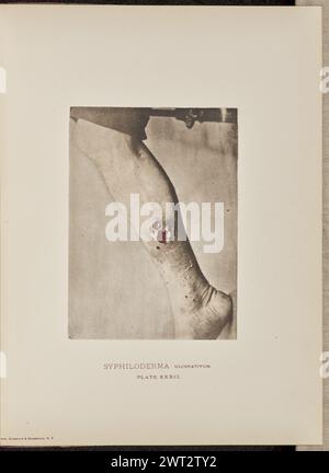 Syphiloderma ulcerativum. Dr. George Henry Fox, photographer (American ...