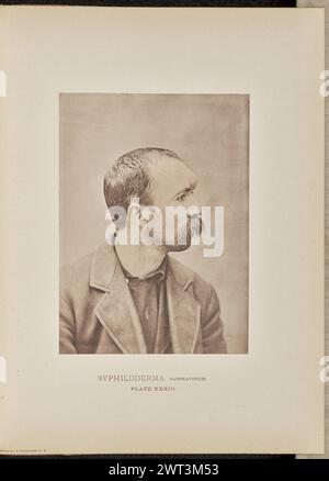 Syphiloderma gummatosum. Dr. George Henry Fox, photographer (American ...