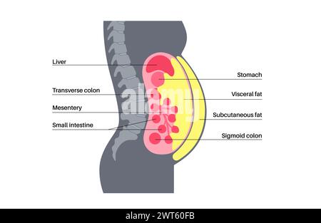 Visceral fat diagram, illustration. Belly fat surrounds internal organs ...