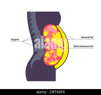 Visceral fat diagram, illustration. Belly fat surrounds internal organs ...