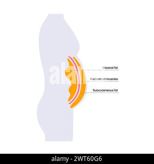 Visceral fat diagram, illustration. Belly fat surrounds internal organs ...