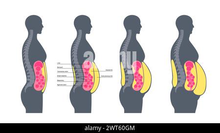 Visceral fat diagram, illustration. Belly fat surrounds internal organs ...