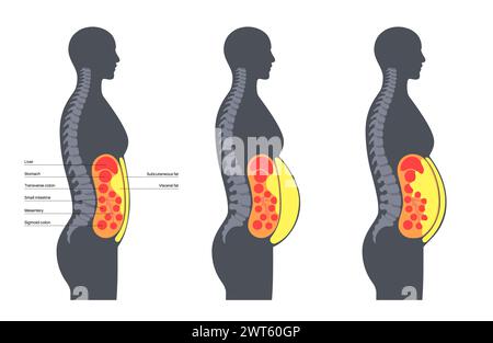 Visceral fat diagram, illustration. Belly fat surrounds internal organs ...