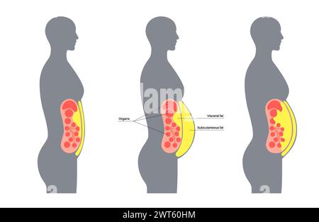 Visceral fat diagram, illustration. Belly fat surrounds internal organs ...