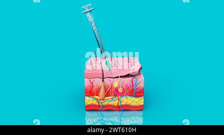 Illustration of an injection into the dermis of the skin Stock Photo ...