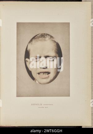 Syphilis hereditaria. Dr. George Henry Fox, photographer (American ...