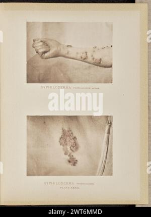 Syphiloderma tuberculosum. Dr. George Henry Fox (American, 1846 - 1937 ...