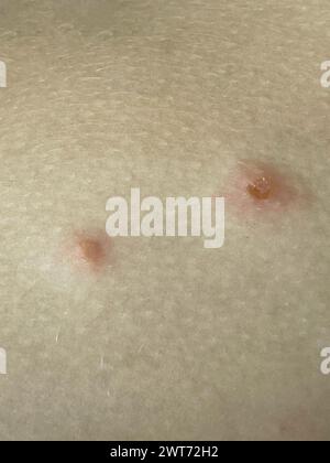 Allergy, dermatitis, virus or bacterial infection on human skin ...