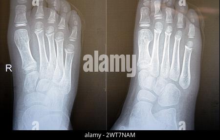 Normal ankle joint, X-ray Stock Photo - Alamy