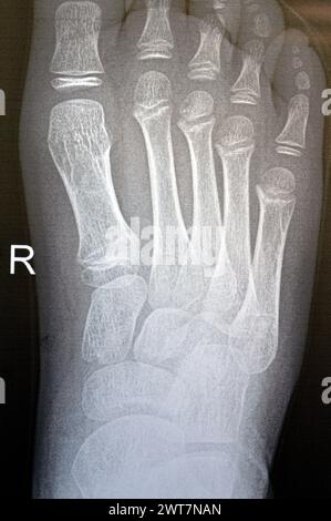 Plain x ray of the right foot of a 9 years old child shows normal ...