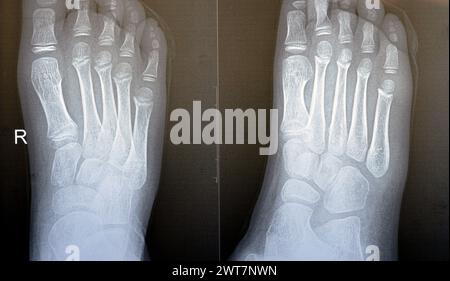 Normal ankle joint, X-ray Stock Photo - Alamy