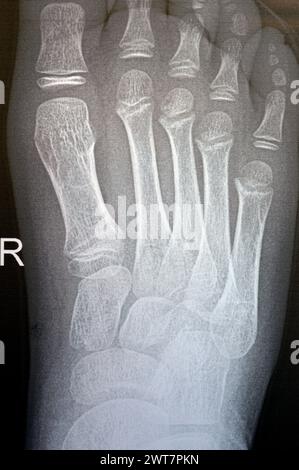 Normal ankle joint, X-ray Stock Photo - Alamy