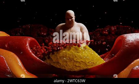 Fat man, blood stream and cholesterol plaque, thrombus. health harm ...