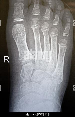 Plain x ray of the right foot of a 9 years old child shows normal ...