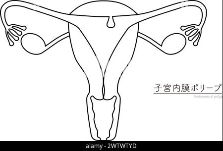 Diagrammatic illustration of endometrial polyps, anatomy of the uterus ...