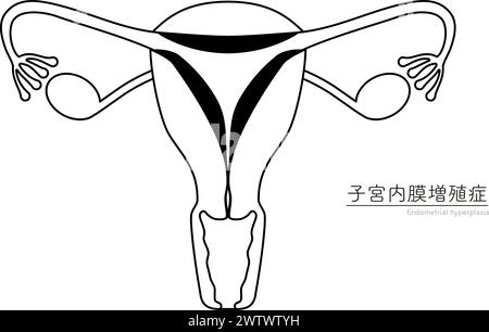Diagrammatic illustration of endometrial hyperplasia, anatomy of the ...