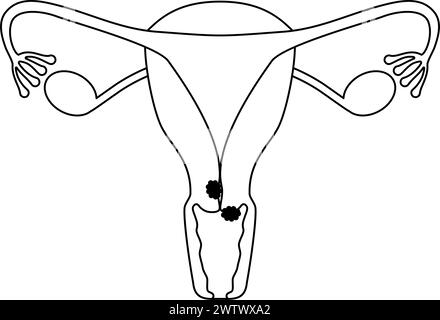 Diagrammatic illustration of cervical cancer, anatomy of the uterus and ...