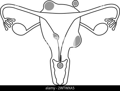 Diagrammatic illustration of uterine fibroids, anatomy of the uterus ...