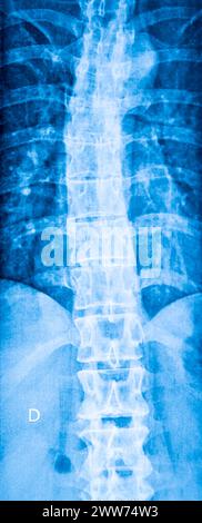X-ray of spine affected by scoliosis, frontal view. Scoliosis 013843 ...