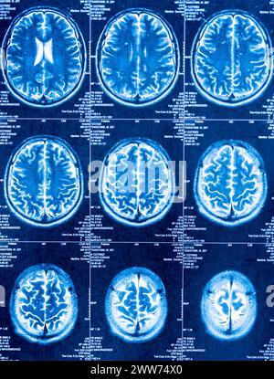 Tomography of the brain obtained by scanner. Brain scan 013843 019 ...