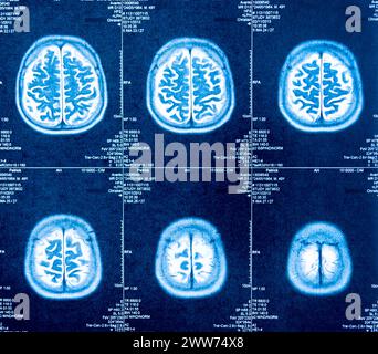 Tomography of the brain obtained by scanner. Brain scan 013843 019 ...