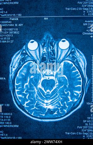Tomography of the brain obtained by scanner. Brain scan 013843 028 ...