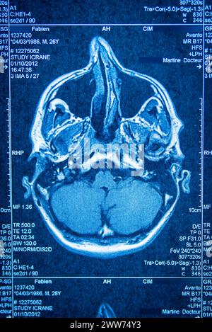 Tomography of the brain obtained by scanner Stock Photo - Alamy