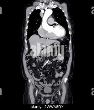 CTA whole aorta imaging coronal view displaying an aortic aneurysm ...