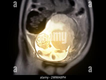 MRI during pregnancy ensures non-invasive evaluation of fetal health ...