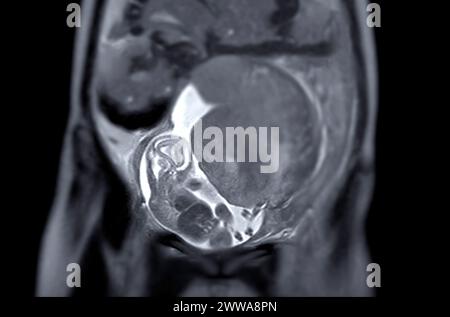 MRI during pregnancy ensures non-invasive evaluation of fetal health ...
