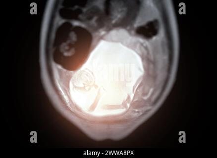 MRI during pregnancy ensures non-invasive evaluation of fetal health ...