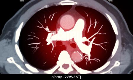 CTPA or CTA pulmonary artery for diagnostic Pulmonary embolism (PE ...