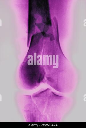 Knee fracture (caused by a violent shock, causing trauma with serious ...