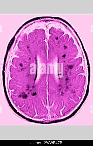 Leukoaraiosis (damage to the small vessels of the cerebral white matter ...