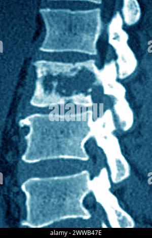 Vertebral osteitis (inflammation of bone tissue in a dorsal vertebra ...