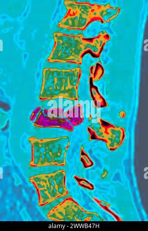 Spontaneous vertebral fracture due to oteoporosis (bone disease ...