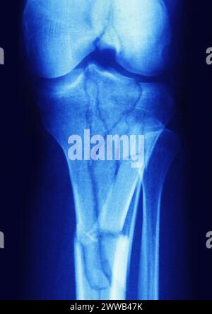 Knee fracture (caused by a violent shock, causing trauma with serious ...