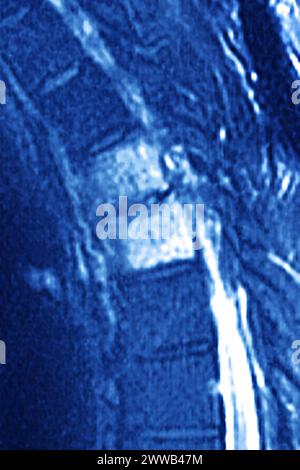 Vertebral osteitis (inflammation of bone tissue in a dorsal vertebra ...