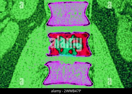 Vertebral osteitis (inflammation of the bone tissue of a lumbar ...